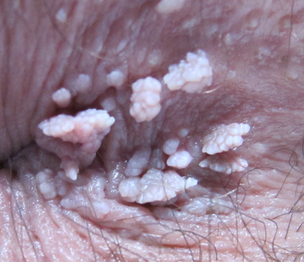 Anal Condyloma | Colon & Rectal Specialist Serving VA | Colon & Rectal ...